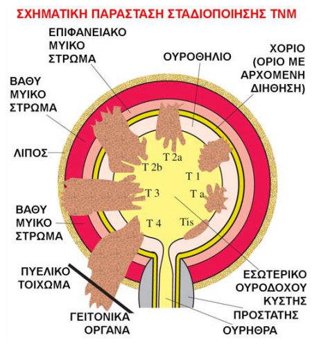 ΟΥΡΟΛΟΓΟΙ – ΧΕΙΡΟΥΡΓΟΙ –ΚΑΡΚΙΝΟΣ ΟΥΡΟΔΟΧΟΥ ΚΥΣΤΕΩΣ